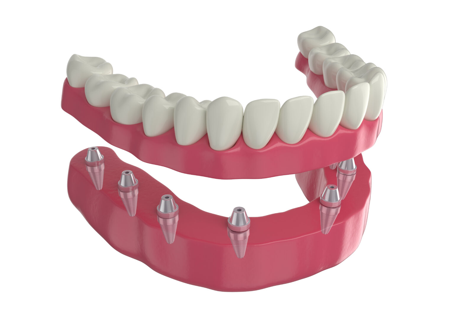 Hybrid Dentures Provide Complete Smiles - Shrewsbury Implant